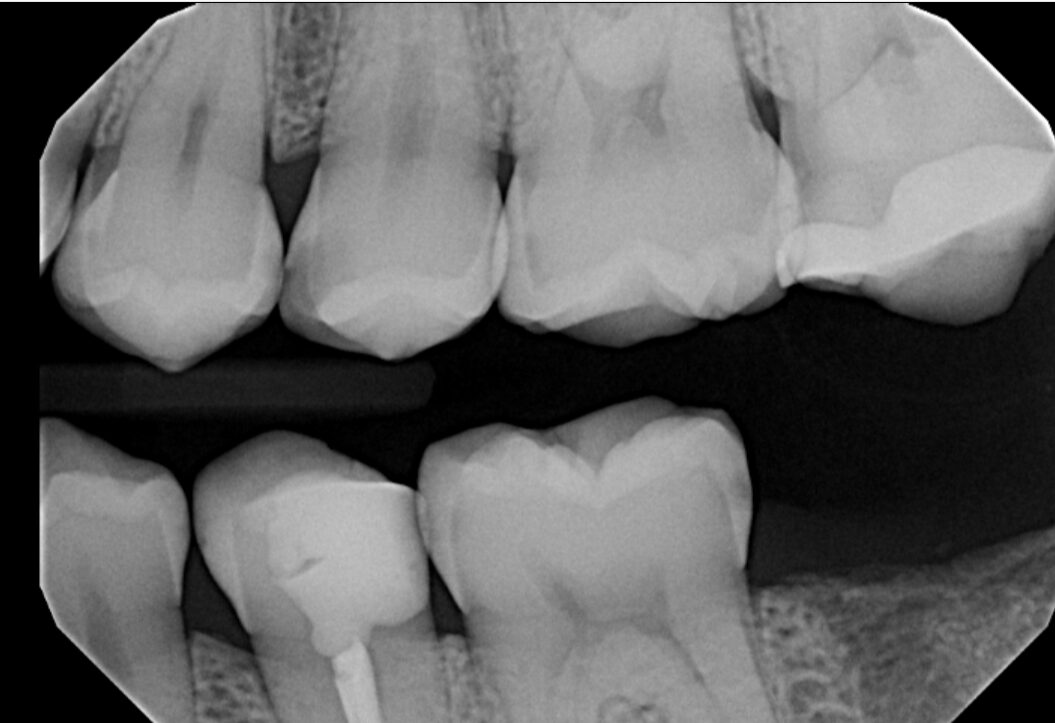 AI Enhanced Dental X-rays & Dental Analysis in Appleton, WI